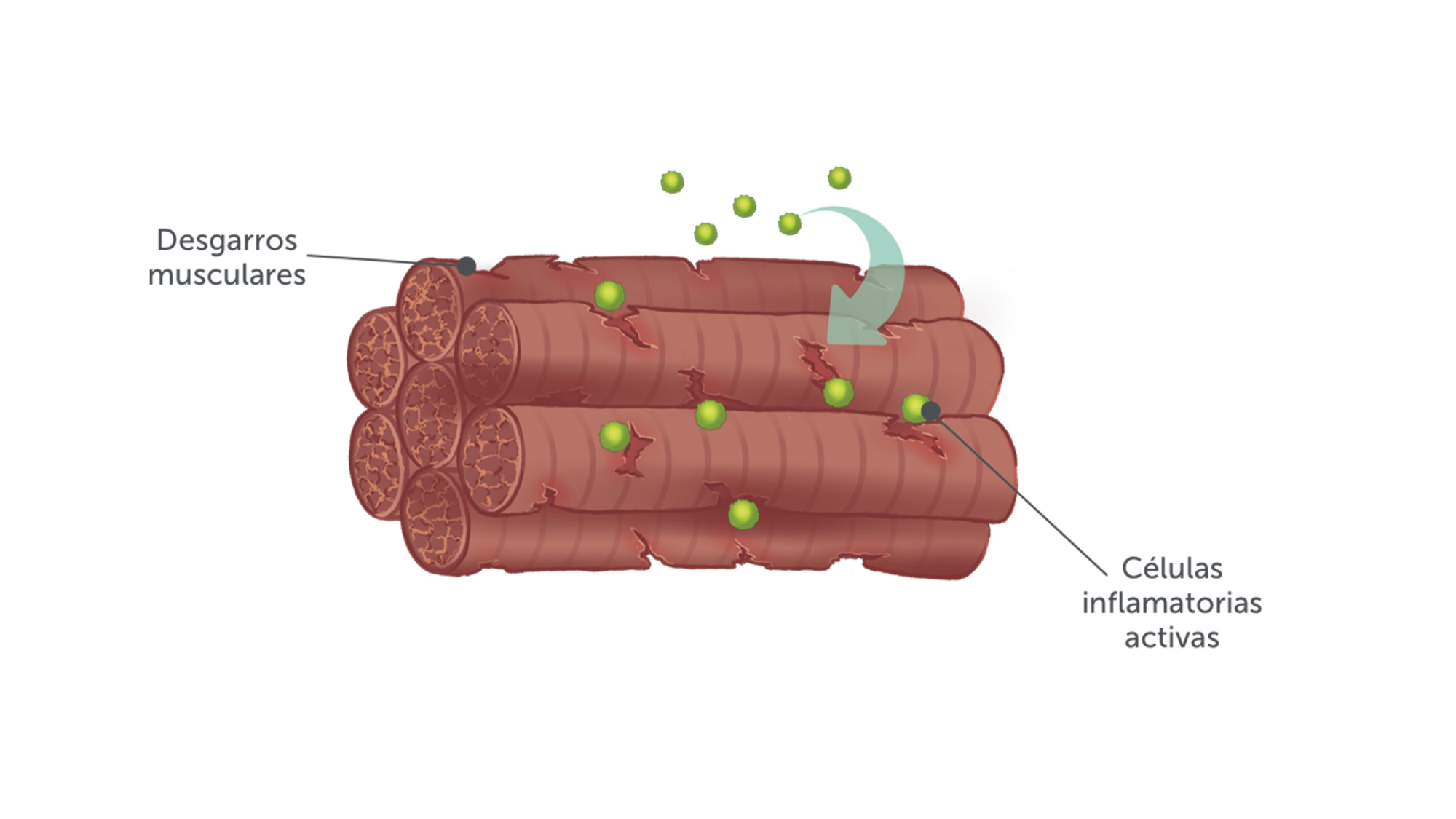 Acerca de la distrofia muscular de Duchenne (DMD)