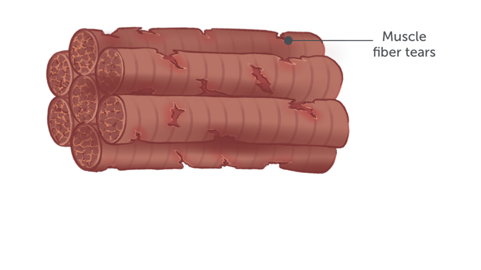 About Duchenne Muscular Dystrophy Dmd